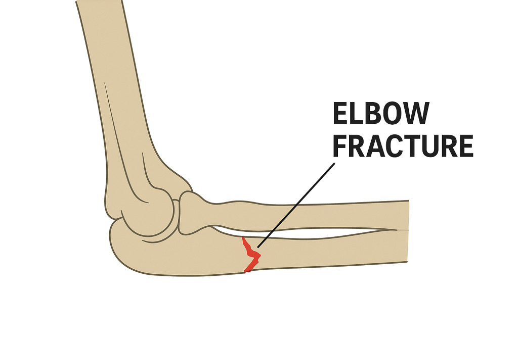 Elbow Fractures Bergen County, NJ - LALL Orthopedics